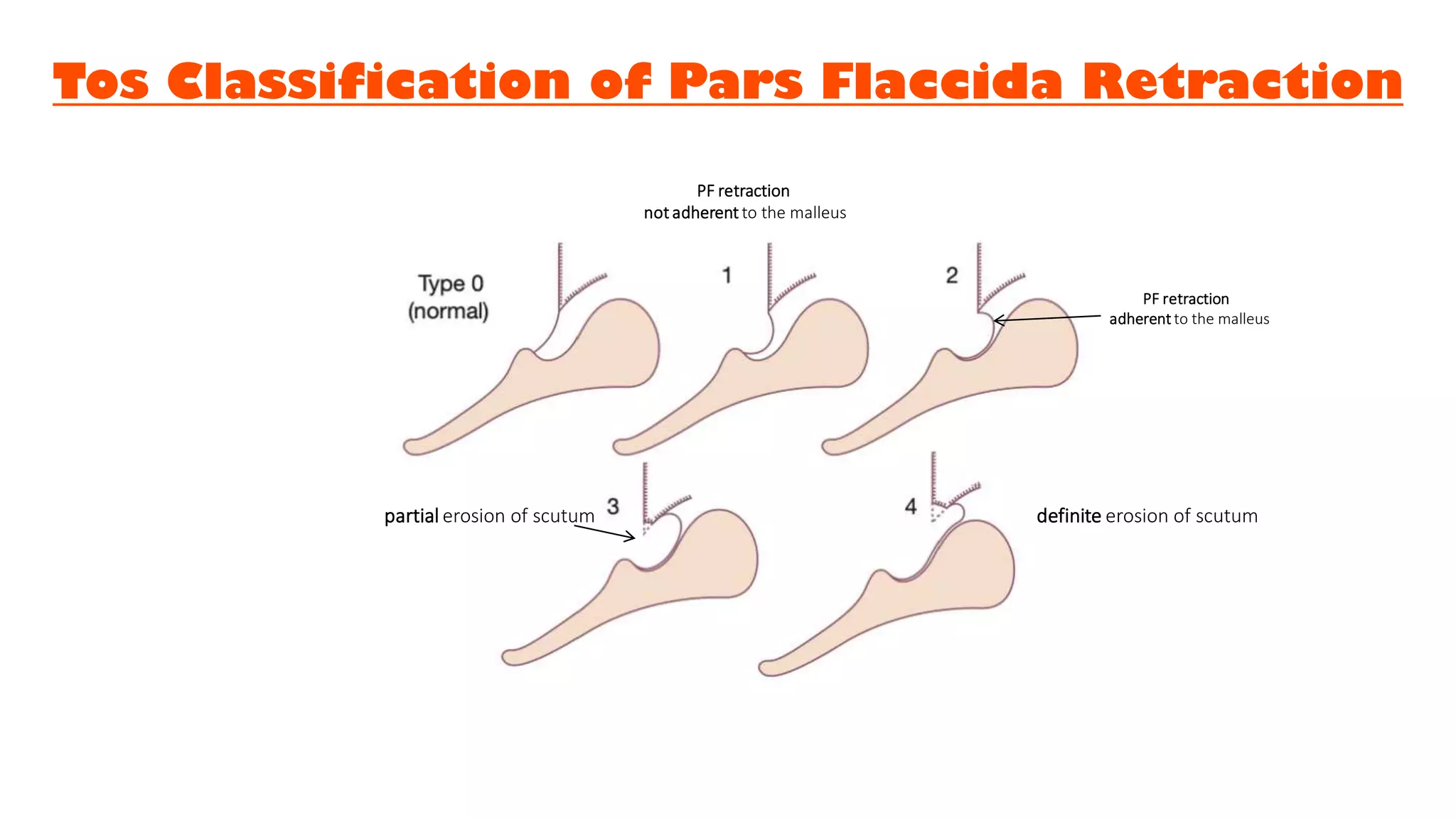 Chronic Otitis Media - Squamosal type ( UG) | PDF