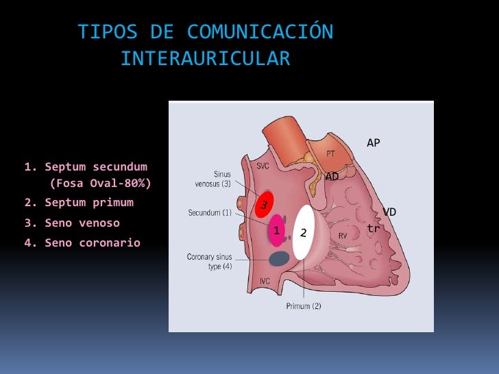 Comunicacin Interauricular Wikipedia La Enciclopedia Libre