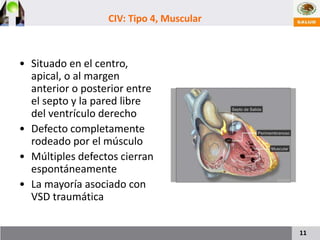 Comunicación interventricular [Ventricular Septal Defect] | PPTX