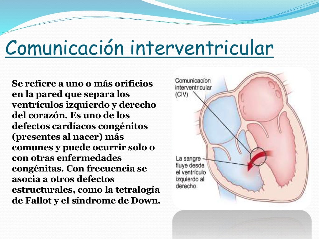 Comunicación Interventricular