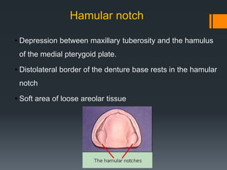 Hamular Notch Maxilla