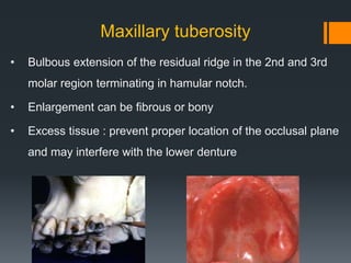Fibrous Maxillary Tuberosity