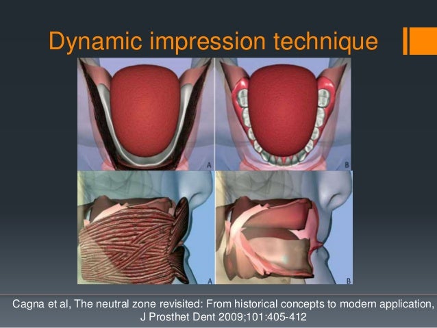 Concept and tecnique of impression making in complete dentures
