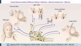 The concept of Brain Death | PPTX