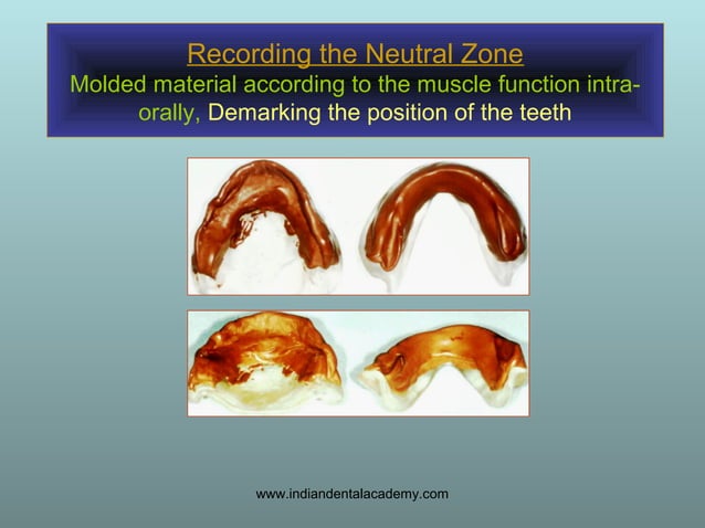 Concept of neutral zone/ dental seminars | PPT