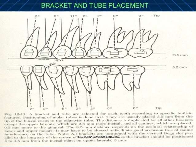 Concepts of bracket positioning techniques..