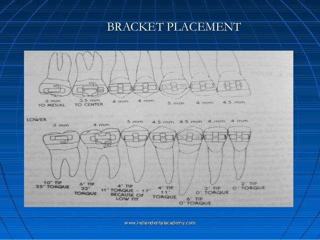 Concepts of orthodontic bracket positioning techniques / fixed orthod…