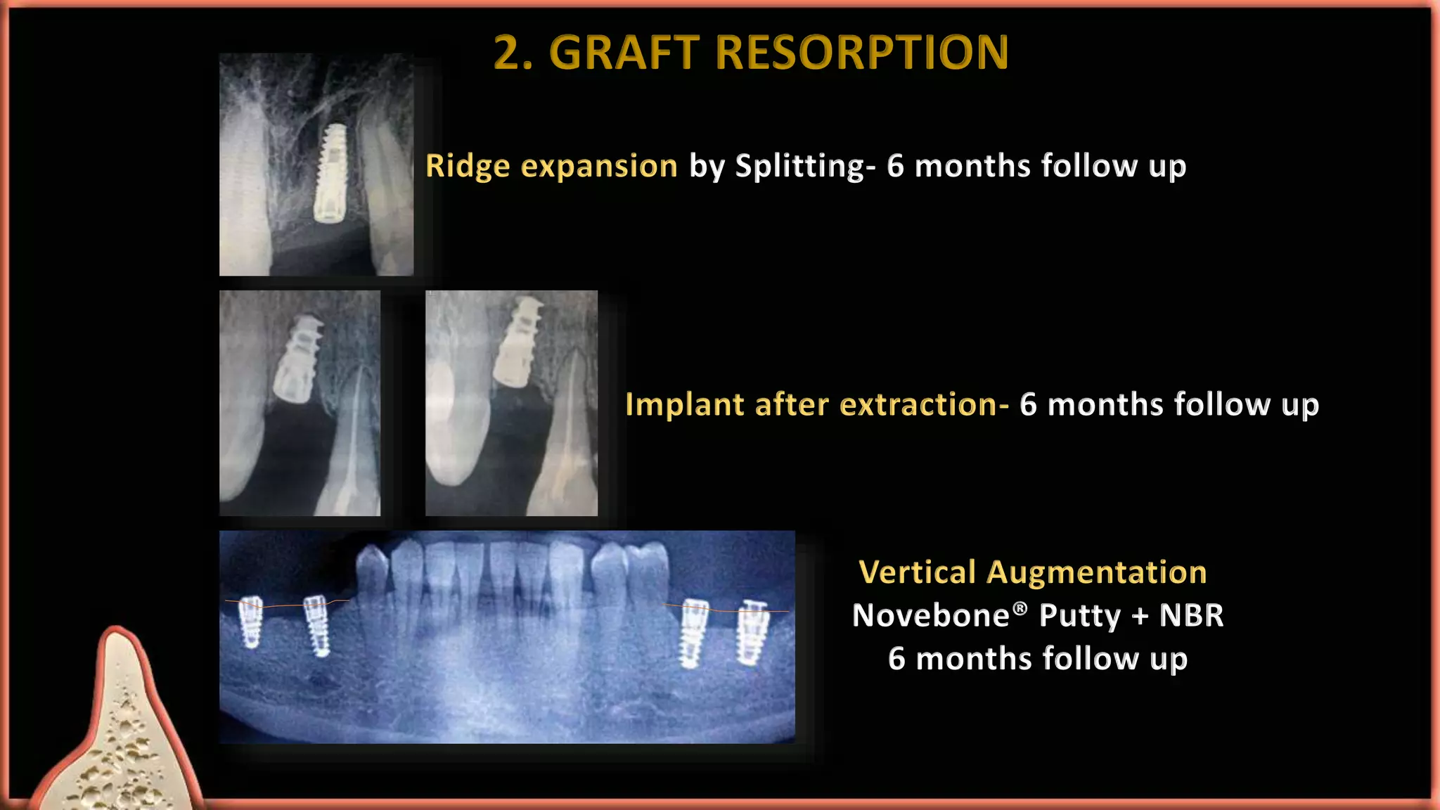 Concepts of ridge augmentation | PPTX