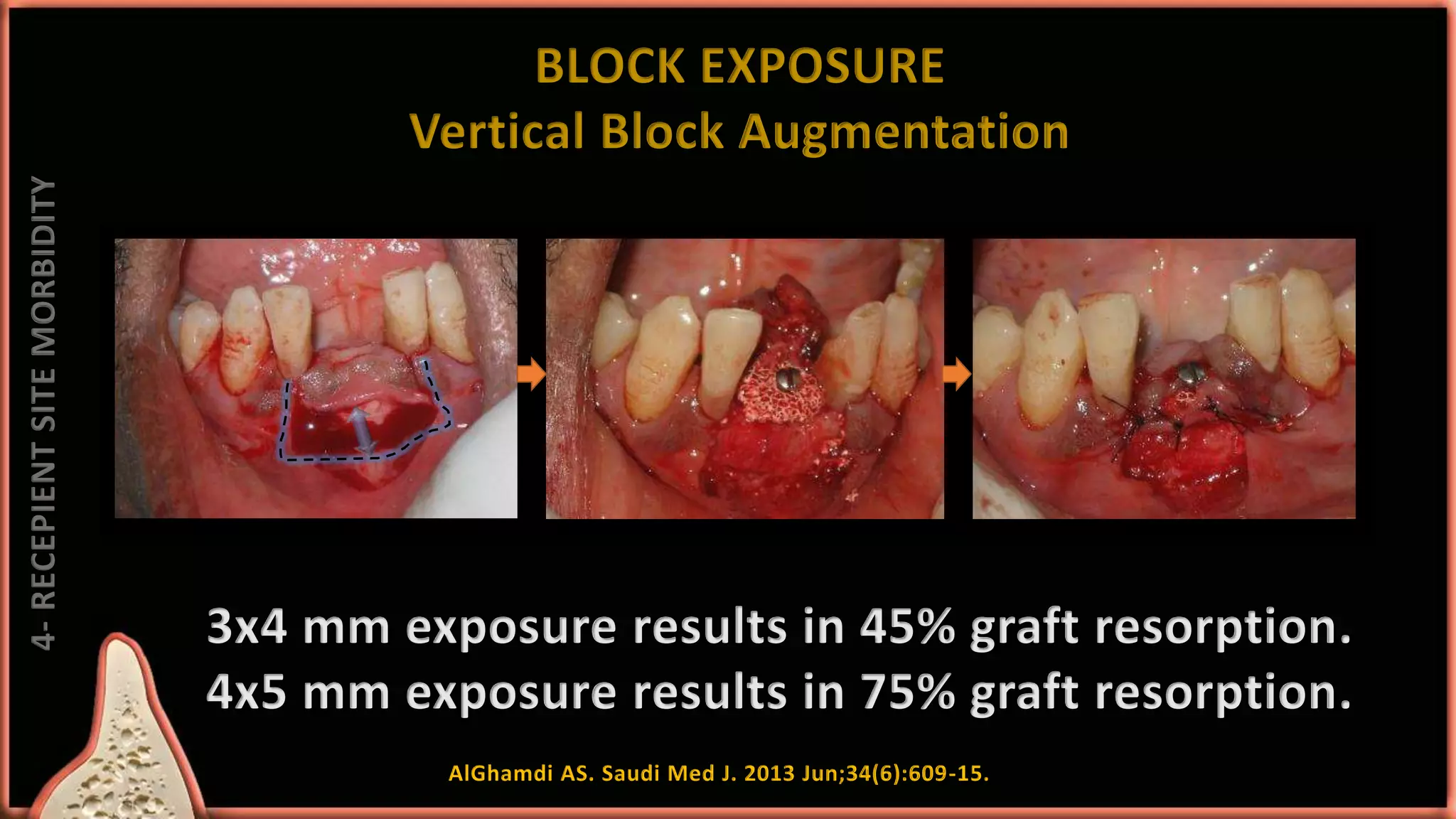 Concepts of ridge augmentation | PPTX