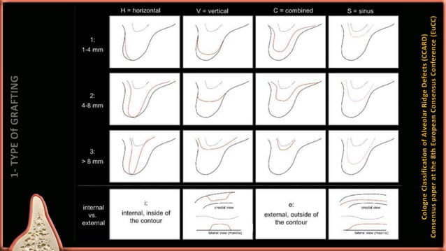 Concepts of ridge augmentation | PPTX