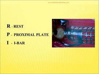 Concepts of rpi/ dentistry dental implants | PPT