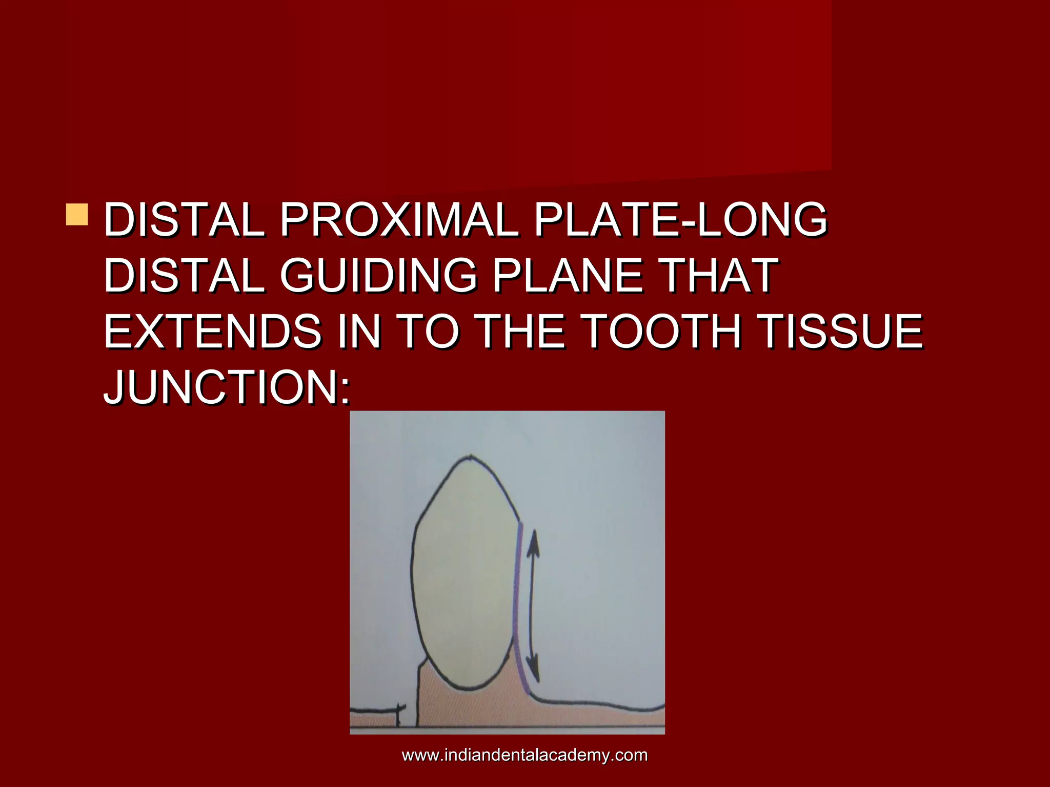Concepts of rpi and indirect retainers copy | PPT