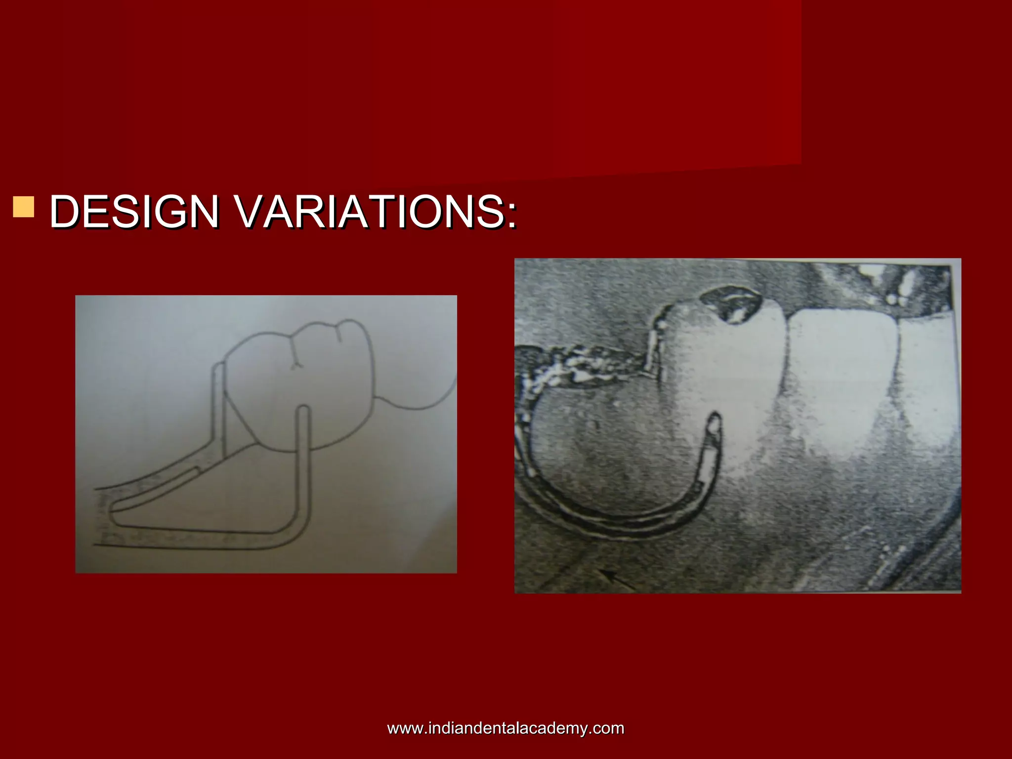 Concepts of rpi and indirect retainers copy | PPT