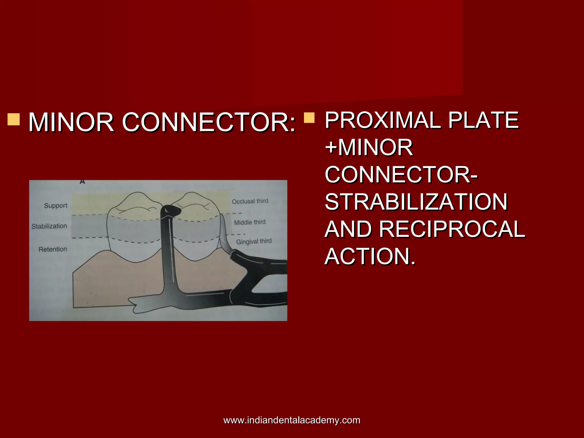 Concepts of rpi and indirect retainers copy | PPT