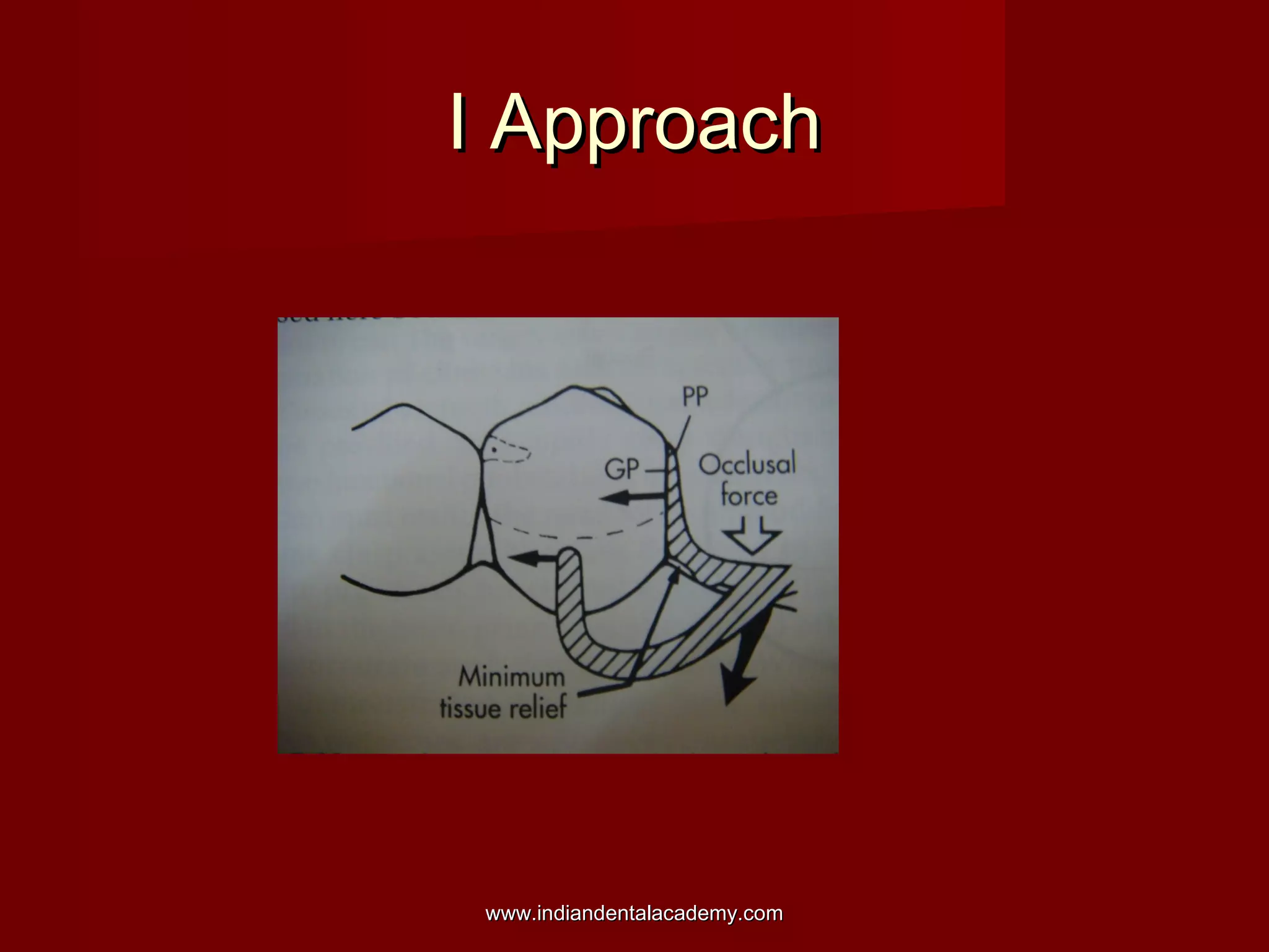 Concepts of rpi and indirect retainers copy | PPT