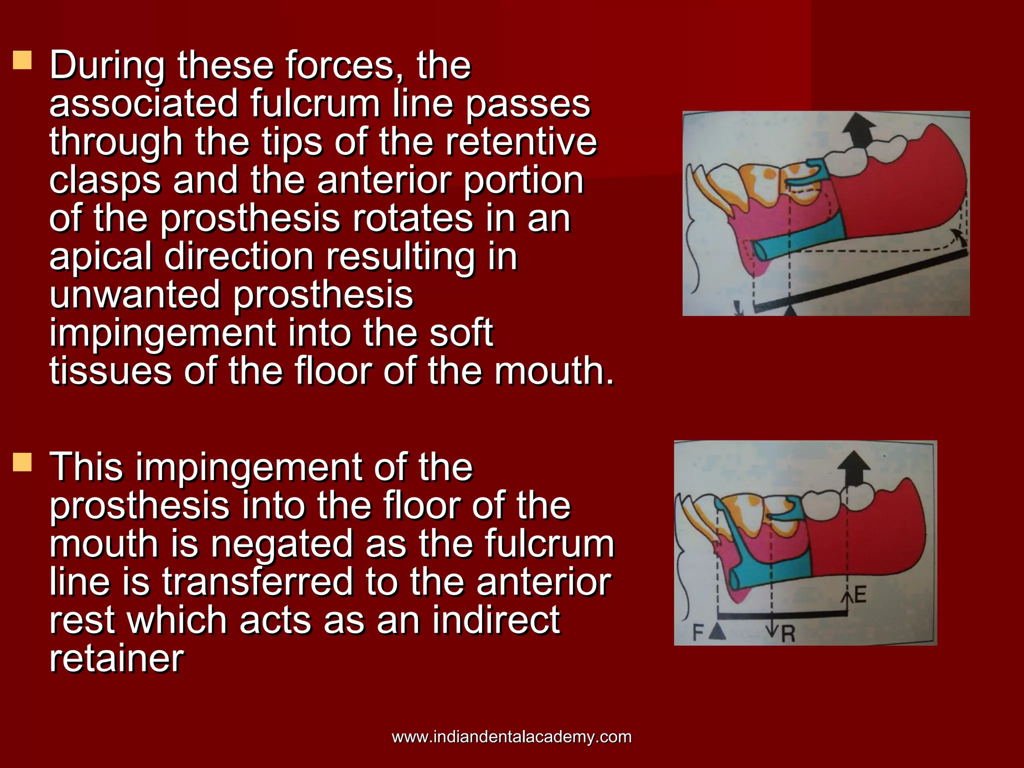 Concepts of rpi and indirect retainers copy | PPT