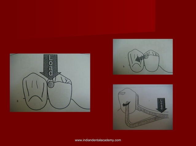 Concepts of rpi and indirect retainers copy | PPT