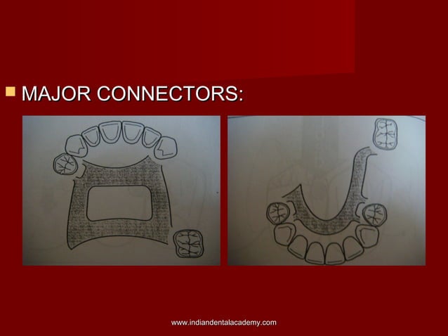 Concepts of rpi and indirect retainers copy | PPT