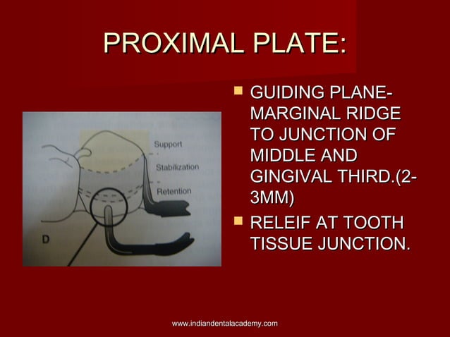 Concepts of rpi and indirect retainers copy | PPT