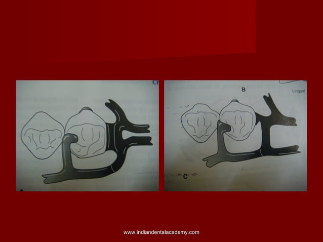 Concepts of rpi and indirect retainers copy | PPT