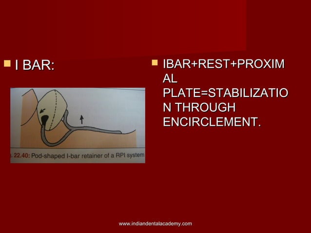 Concepts of rpi and indirect retainers copy | PPT