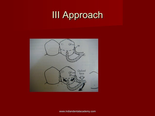 Concepts of rpi and indirect retainers copy | PPT