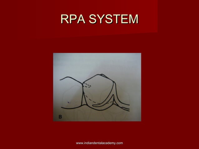 Concepts of rpi and indirect retainers copy | PPT