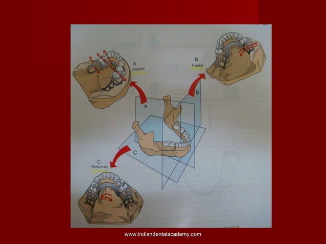 Concepts of rpi and indirect retainers copy | PPT