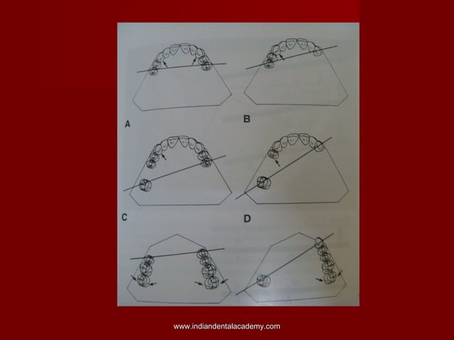 Concepts of rpi and indirect retainers copy | PPT