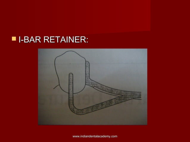 Concepts of rpi and indirect retainers copy | PPT