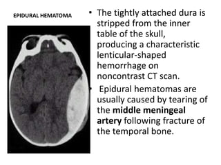 Concussion and other head injuries | PPTX