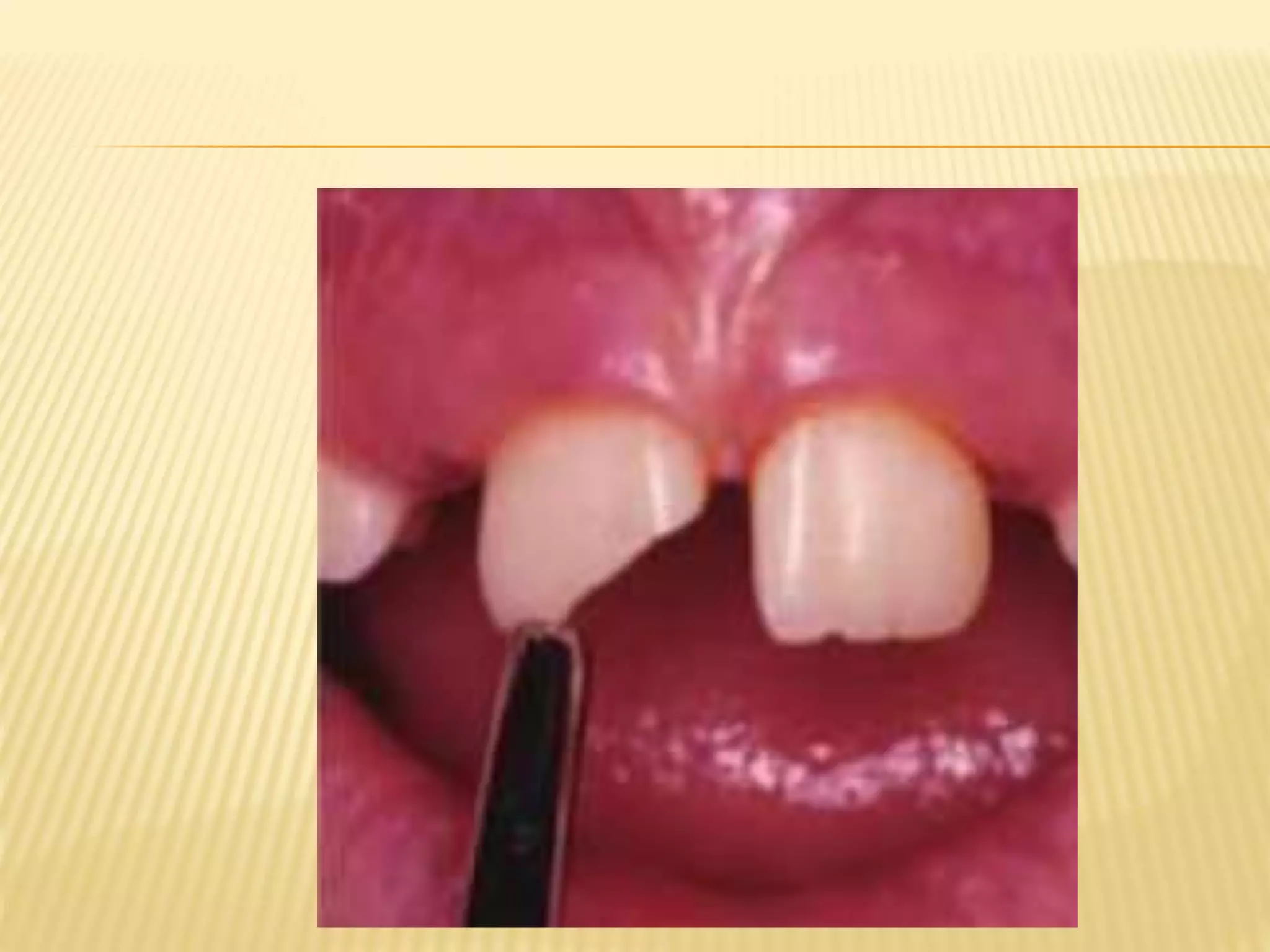 Concussion and subluxation | PPTX