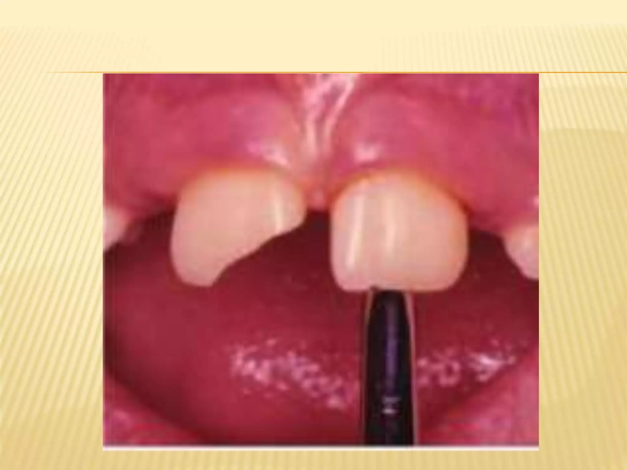 Concussion and subluxation | PPTX