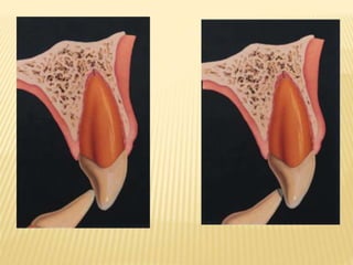 Concussion and subluxation | PPTX