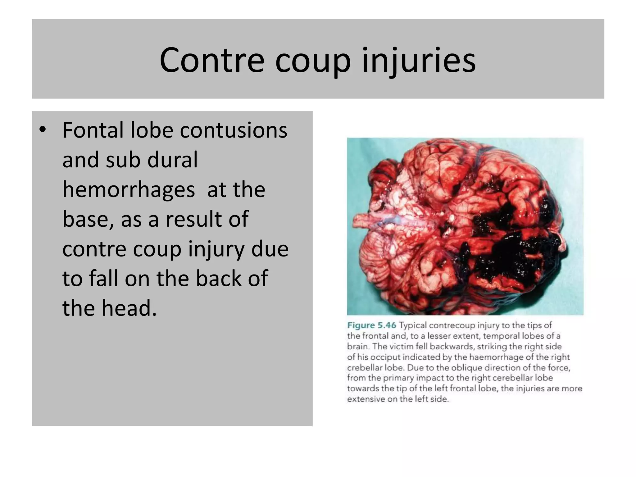 contre coup injury,Concussion,DAI, EDH- forensic aspects | PPT