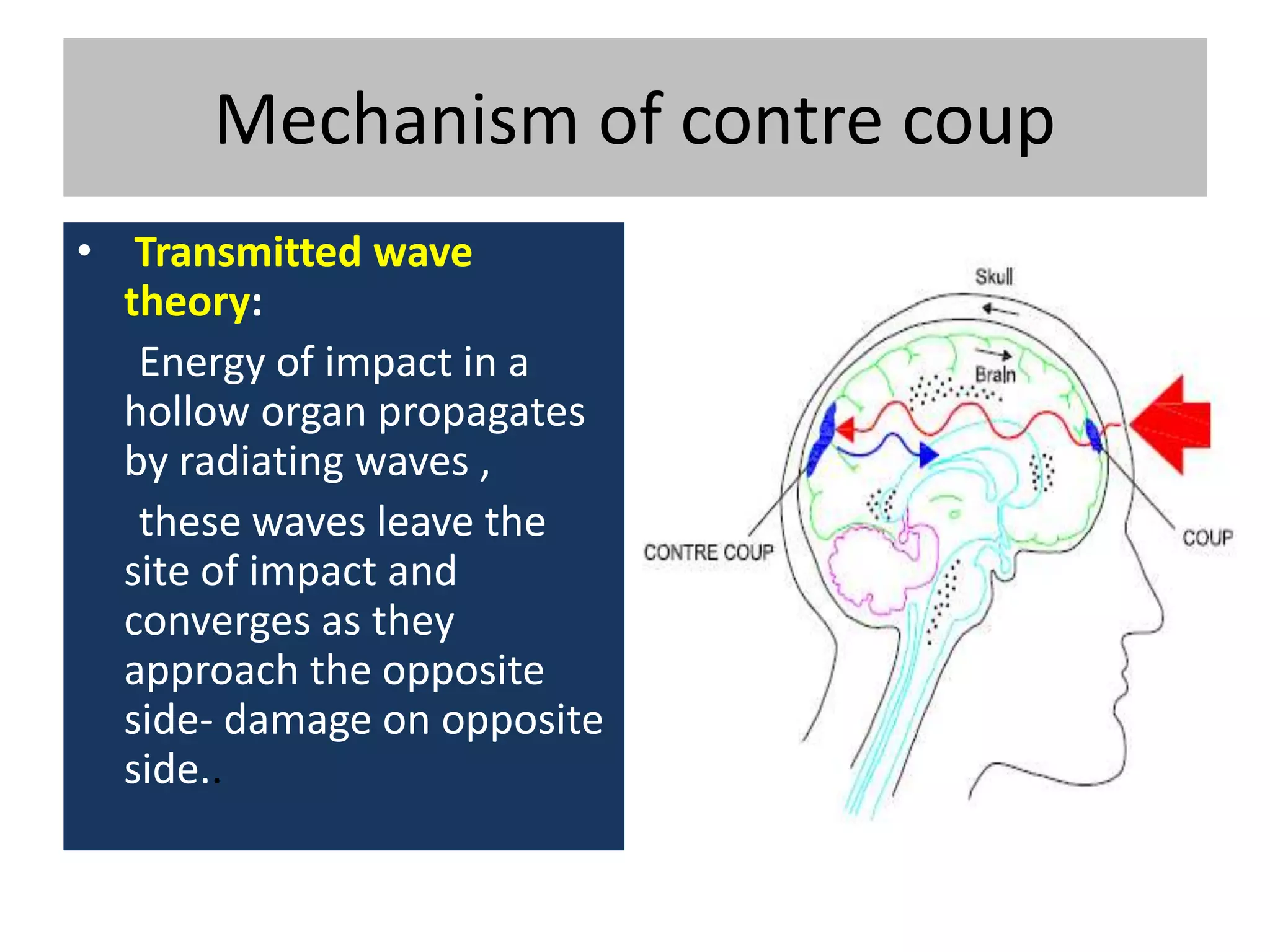 contre coup injury,Concussion,DAI, EDH- forensic aspects | PPT