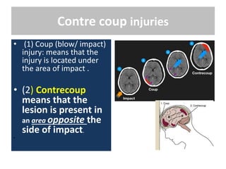 contre coup injury,Concussion,DAI, EDH- forensic aspects | PPTX