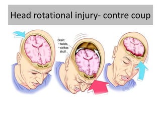 contre coup injury,Concussion,DAI, EDH- forensic aspects | PPTX