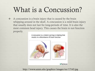 Concussions | PPT