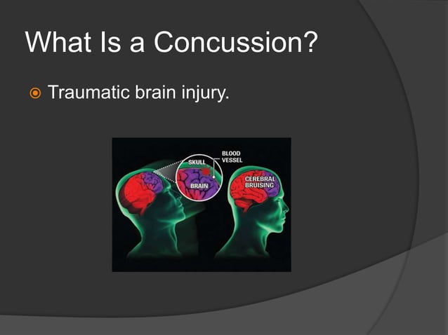 Concussions | PPT