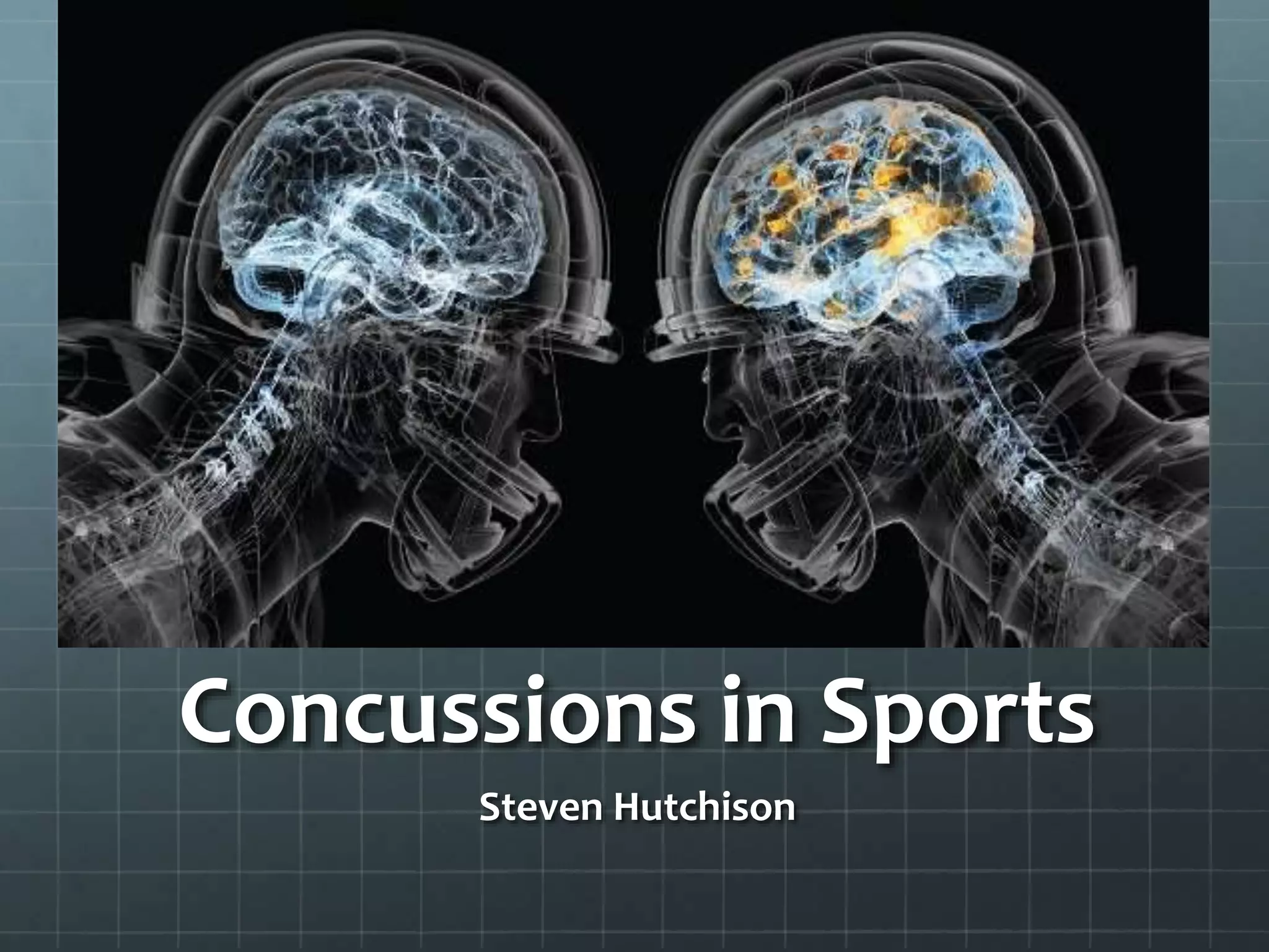 Concussions in sports | PPT