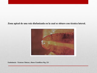 Condensacion lateral | PPT