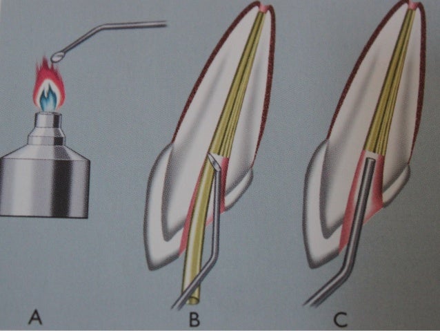 Condensacion lateral