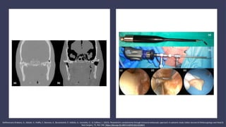CONDILECTOMIA INTRAORAL TECNICA INTRAORAL COMPILACION | PPT