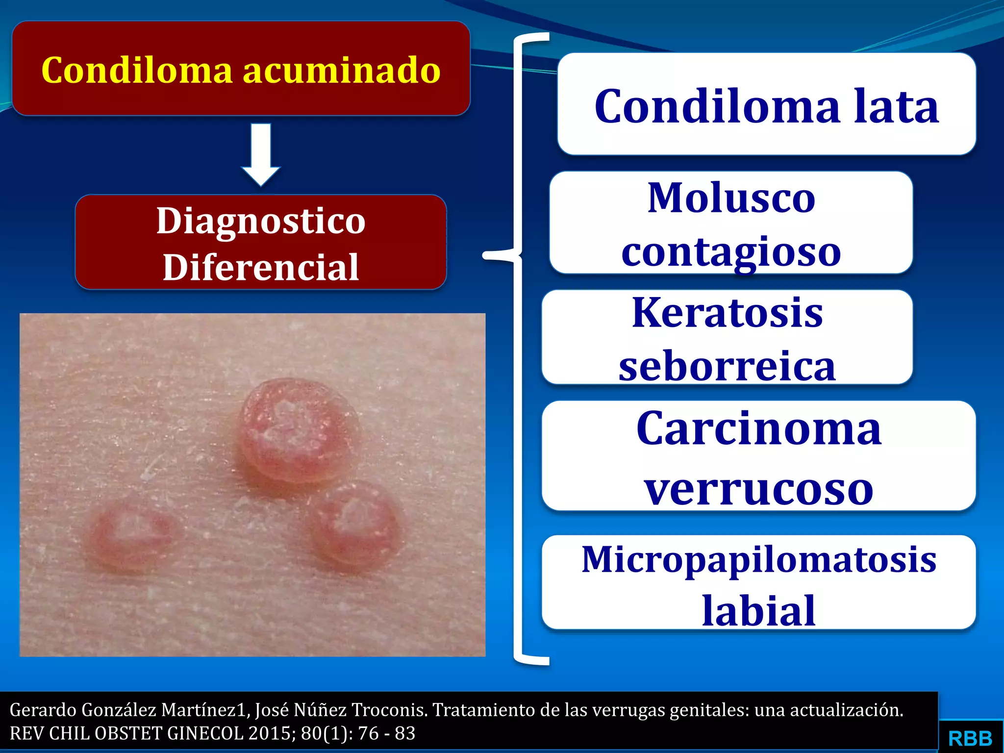 CONDILOMA ACUMINADO | PPTX