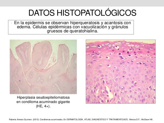 Condilomas acuminados