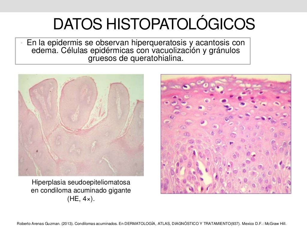 Condilomas acuminados