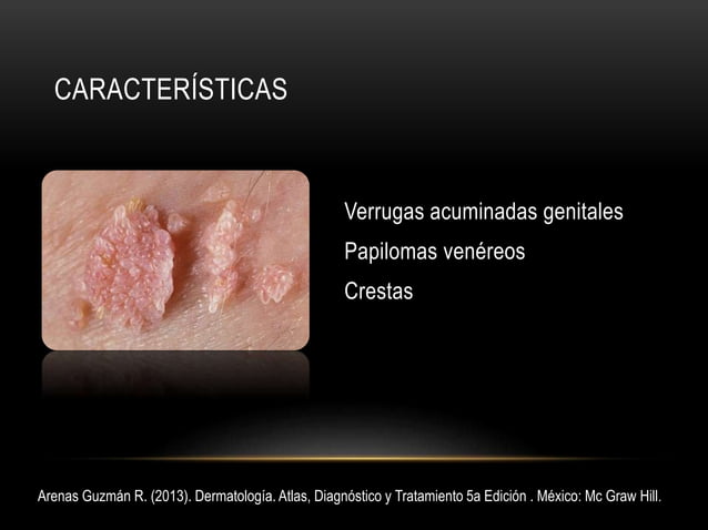 Condilomas acuminados | PPT