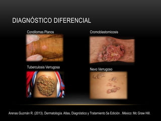 Condilomas acuminados | PPT