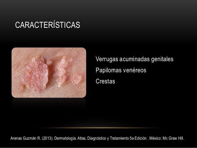Condilomas acuminados